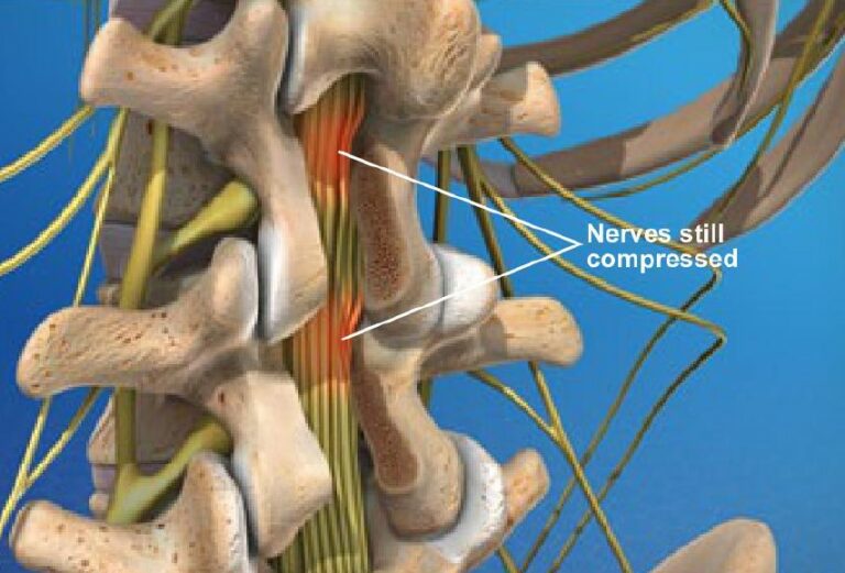 Post laminectomy Syndrome 2 STL MISC Post laminectomy Syndrome 2 STL MISC