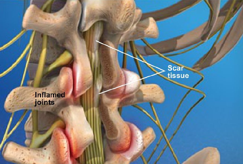 Post laminectomy Syndrome 3 STL MISC Post laminectomy Syndrome 3 STL MISC