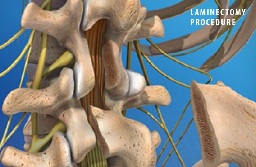 Post laminectomy Syndrome STL MISC Post laminectomy Syndrome STL MISC